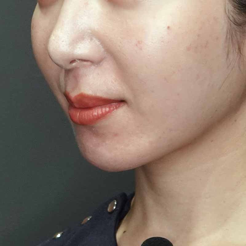人中のボトックスの症例写真 Ι 執刀医：中村 芳帆 Ι 美容整形なら水の森美容クリニック