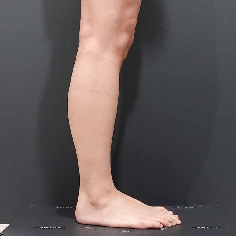 ふくらはぎのボトックス注射の症例写真 Ι 執刀医：田中 邦和 Ι 美容整形なら水の森美容クリニック