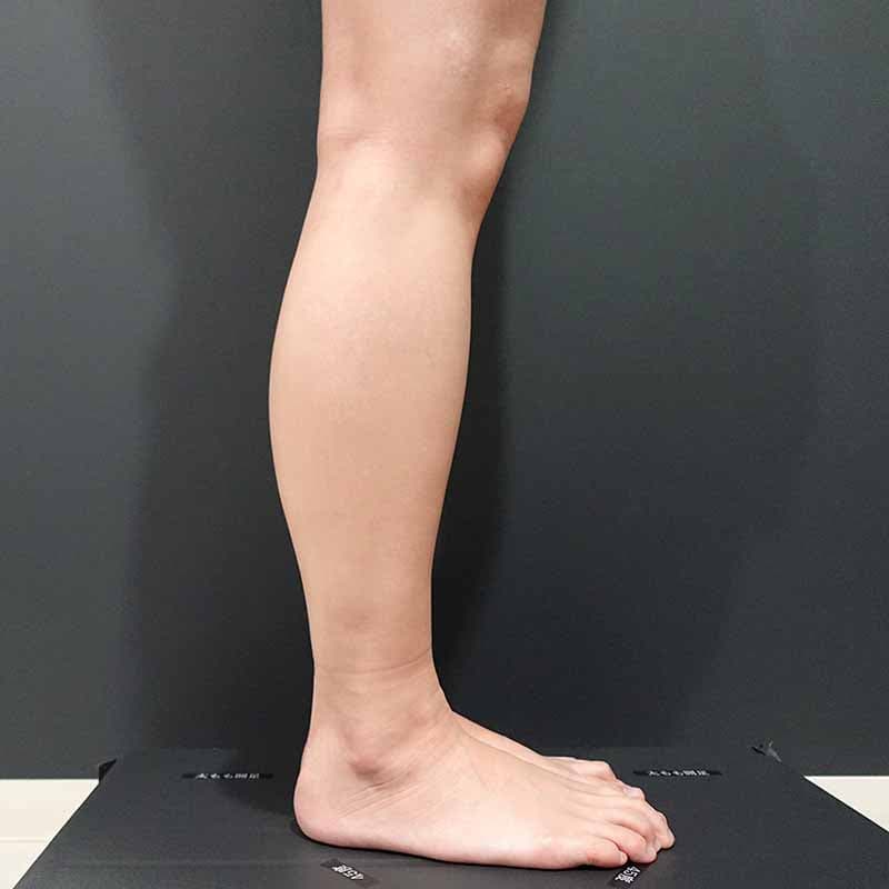 ふくらはぎのボトックス注射の症例写真 Ι 執刀医：田中 邦和 Ι 美容整形なら水の森美容クリニック