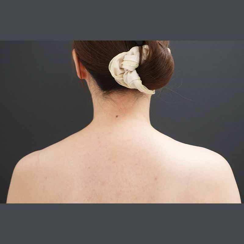 肩のボトックス注射の症例写真 Ι 執刀医：永濱 宏章 | 美容整形なら水の森美容クリニック