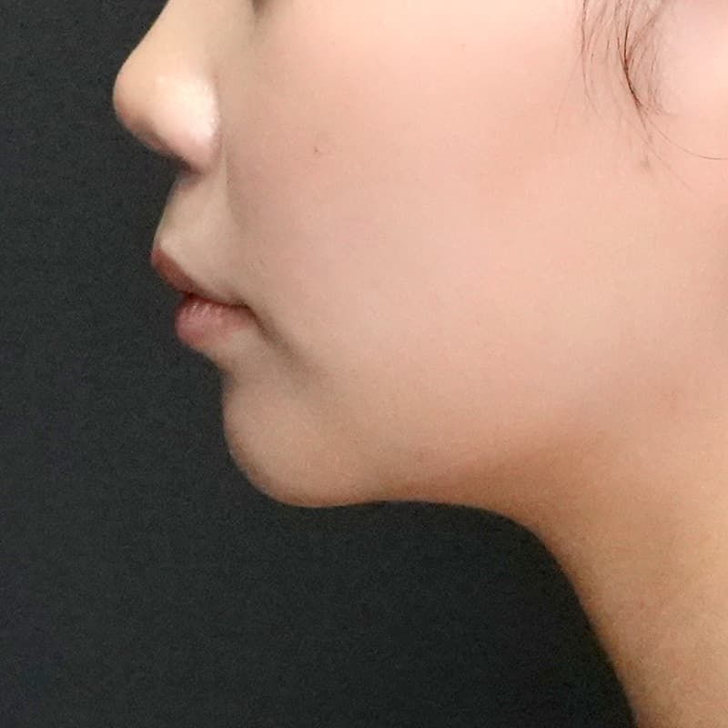 人中のボトックスの症例写真・ビフォーアフター Ι 執刀医：小糸 秀 Ι 美容整形なら水の森美容クリニック