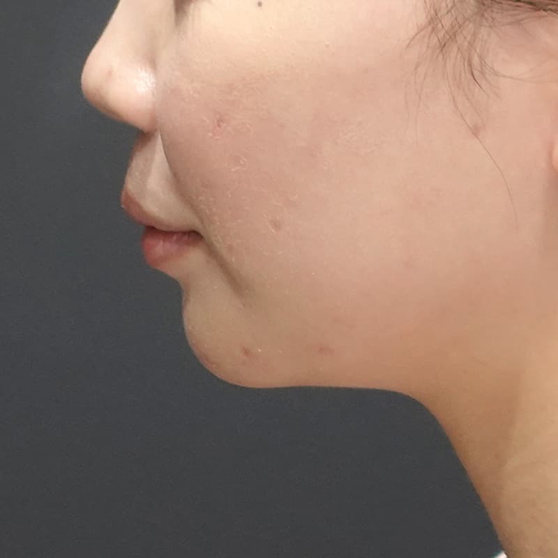 人中のボトックスの症例写真・ビフォーアフター Ι 執刀医：小糸 秀 Ι 美容整形なら水の森美容クリニック