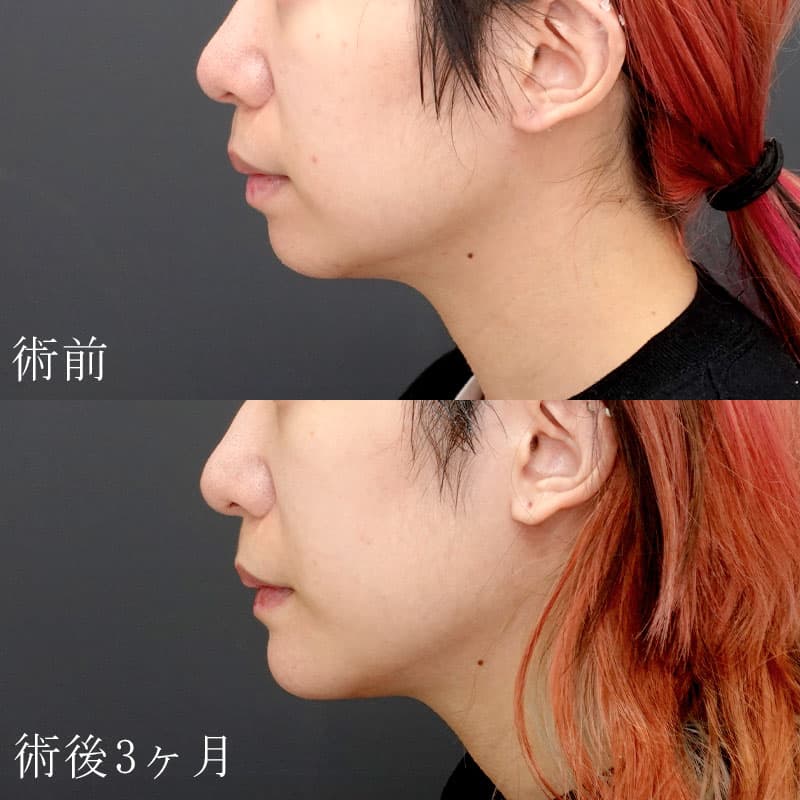 顎プロテーゼの症例写真・ビフォーアフター Ι 執刀医：竹村 和紀 | 美容整形なら水の森美容クリニック