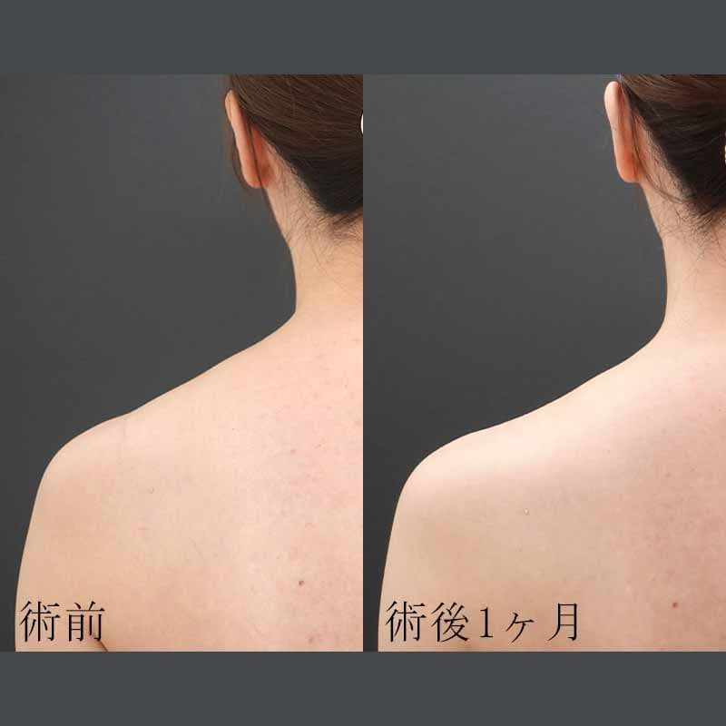 肩のボトックス注射の症例写真・ビフォーアフター | 執刀医：永濱 宏章 | 美容整形なら水の森美容クリニック