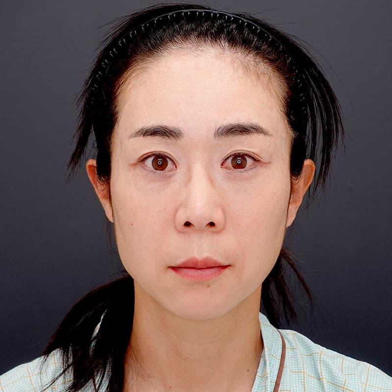 フェイスリフトの症例写真・ビフォーアフター | 執刀医：竹村 和紀 | 美容整形なら水の森美容クリニック