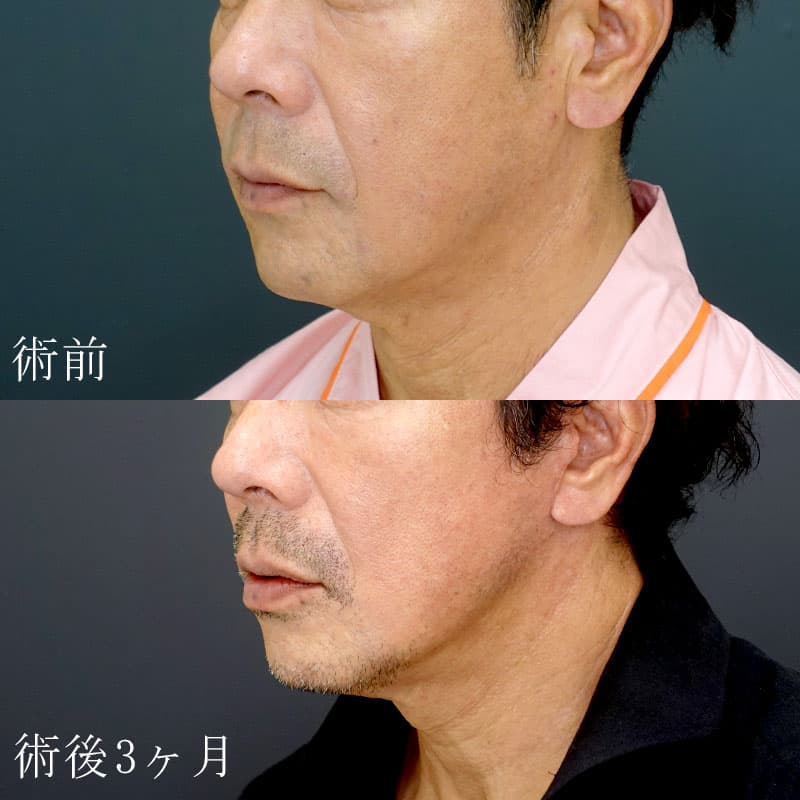 フェイスリフトの症例写真・ビフォーアフター | 執刀医：竹村 和紀 | 美容整形なら水の森美容クリニック