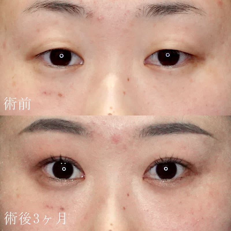 二重切開法の症例写真・ビフォーアフター | 執刀医：竹村 和紀 | 美容整形なら水の森美容クリニック【公式】