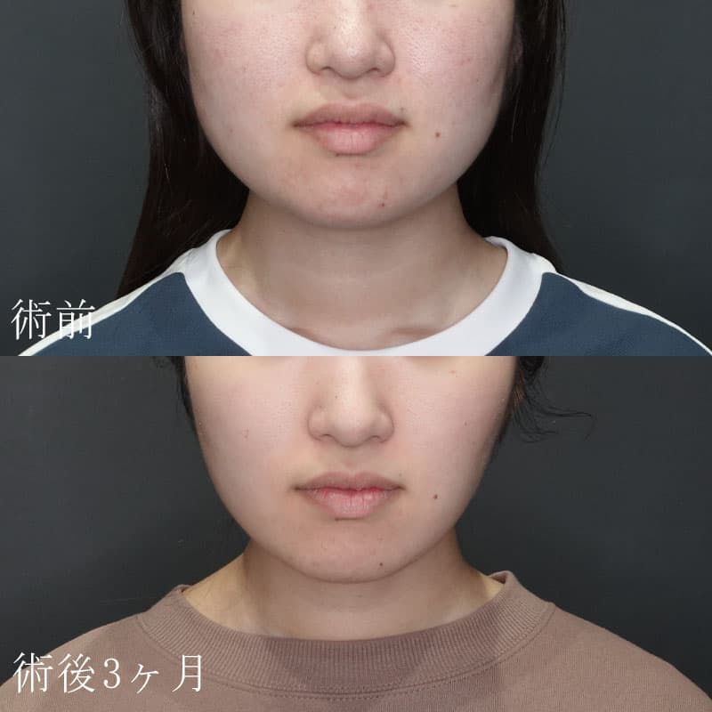 顔の脂肪吸引（頬＋顎下）＋エラのボトックス注射の症例写真・ビフォーアフター Ι 竹村 和紀 | 水の森美容クリニック