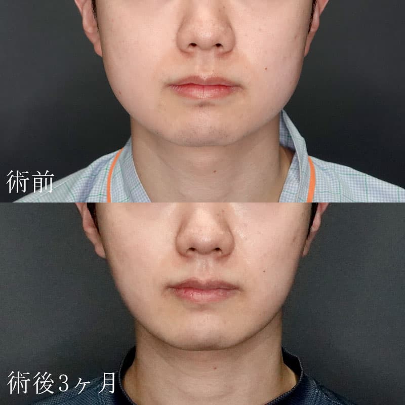 顔の脂肪吸引（頬＋顎下）＋エラのボトックス注射の症例写真・ビフォーアフター Ι 竹村 和紀 | 水の森美容クリニック