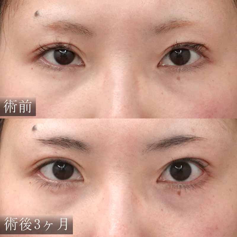 たれ目形成＋目尻切開の症例写真・ビフォーアフター Ι 執刀医：小糸 秀 | 美容整形なら水の森美容クリニック【公式】